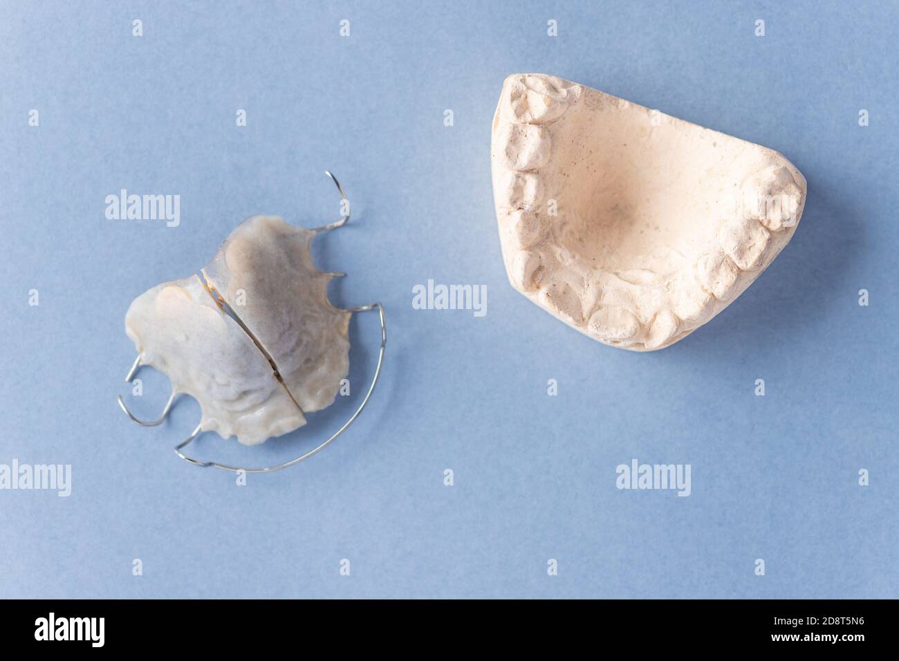 Removable orthodontic plate and plaster cast of child's jaw on blue ...