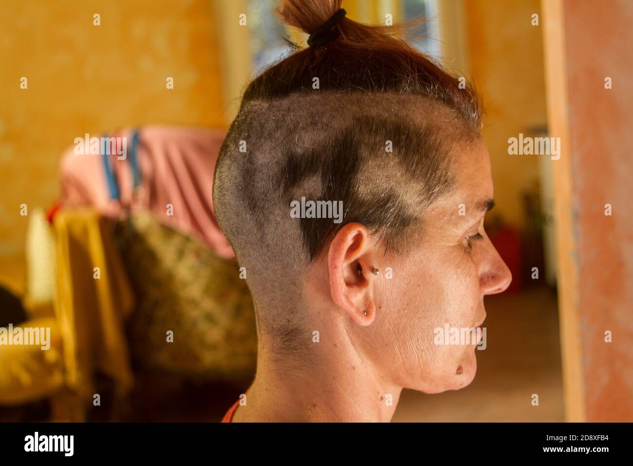 Pressure alopecia hi-res stock photography and images - Alamy