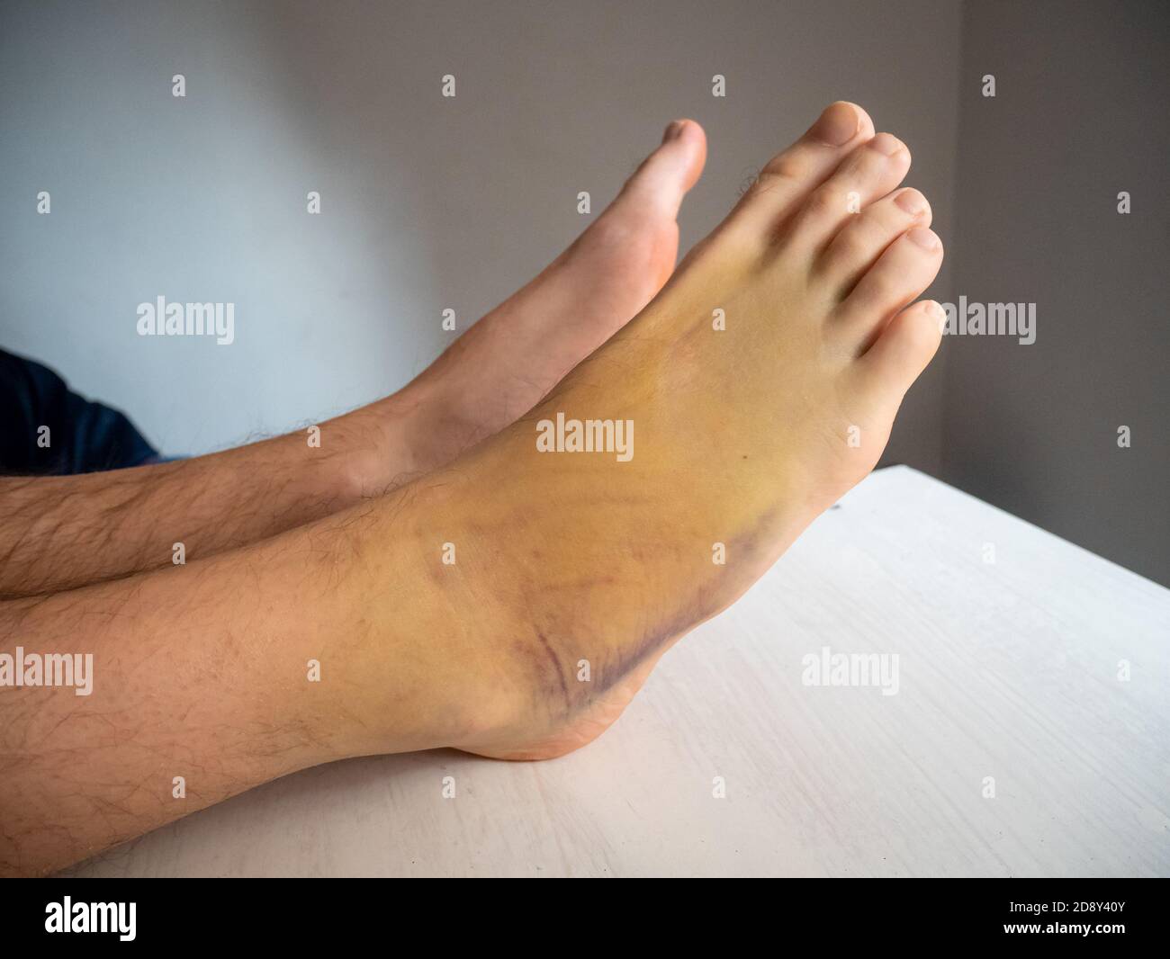 Right Foot Bruise, also known as Contusion on a Large Area with Stock ...