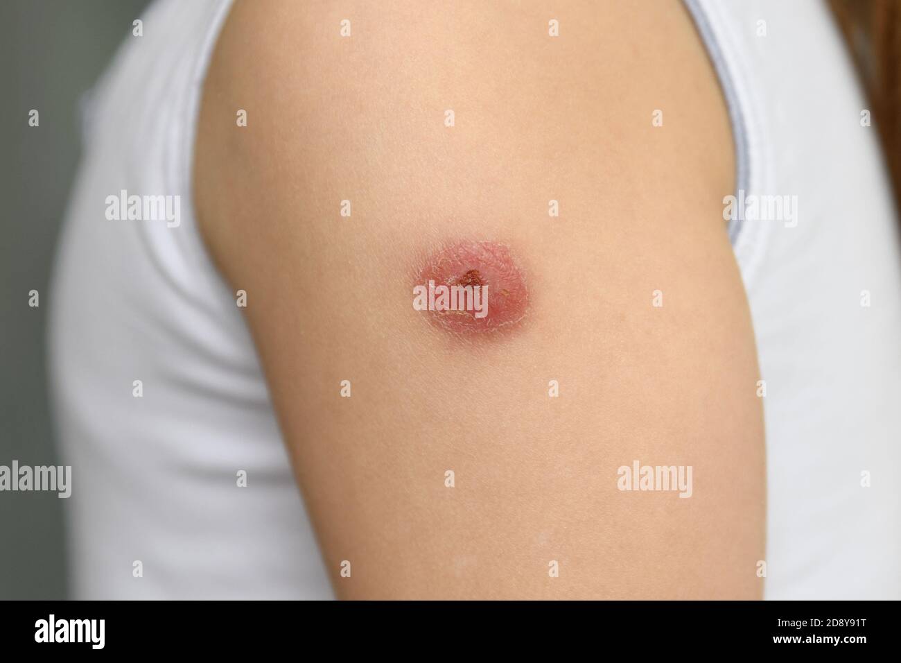 Bcg vaccine hi-res stock photography and images - Alamy