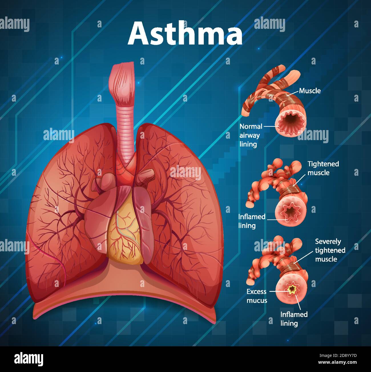 Comparison of healthy lung and Asthmatic lung illustration Stock Vector ...