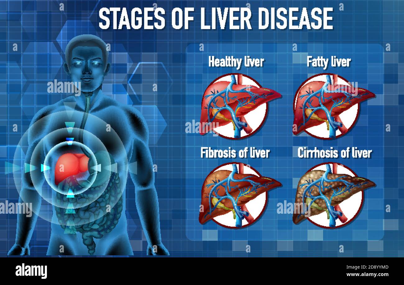 Stages of liver disease illustration Stock Vector Image & Art - Alamy