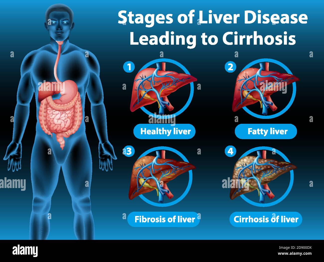 Stages of liver disease leading to Cirrhosis illustration Stock Vector ...