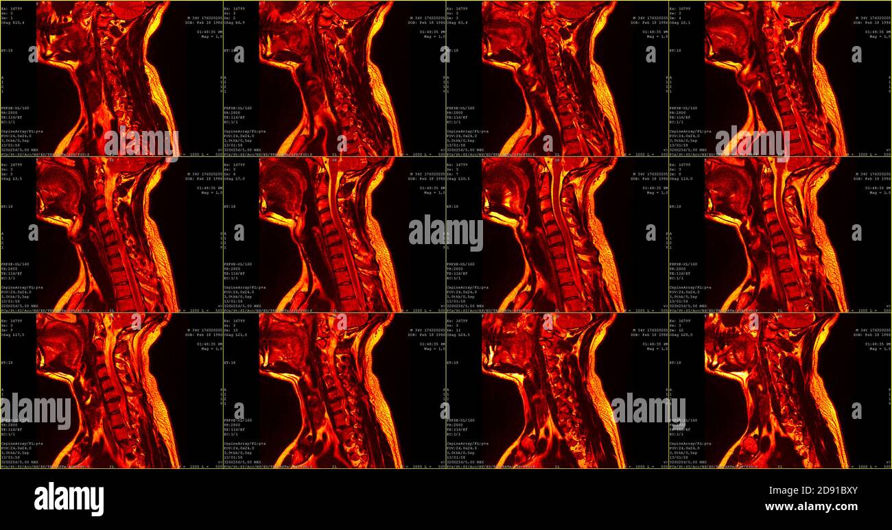 set of 12 sagittal red colored MRI scans of neck area of caucasian 34 ...