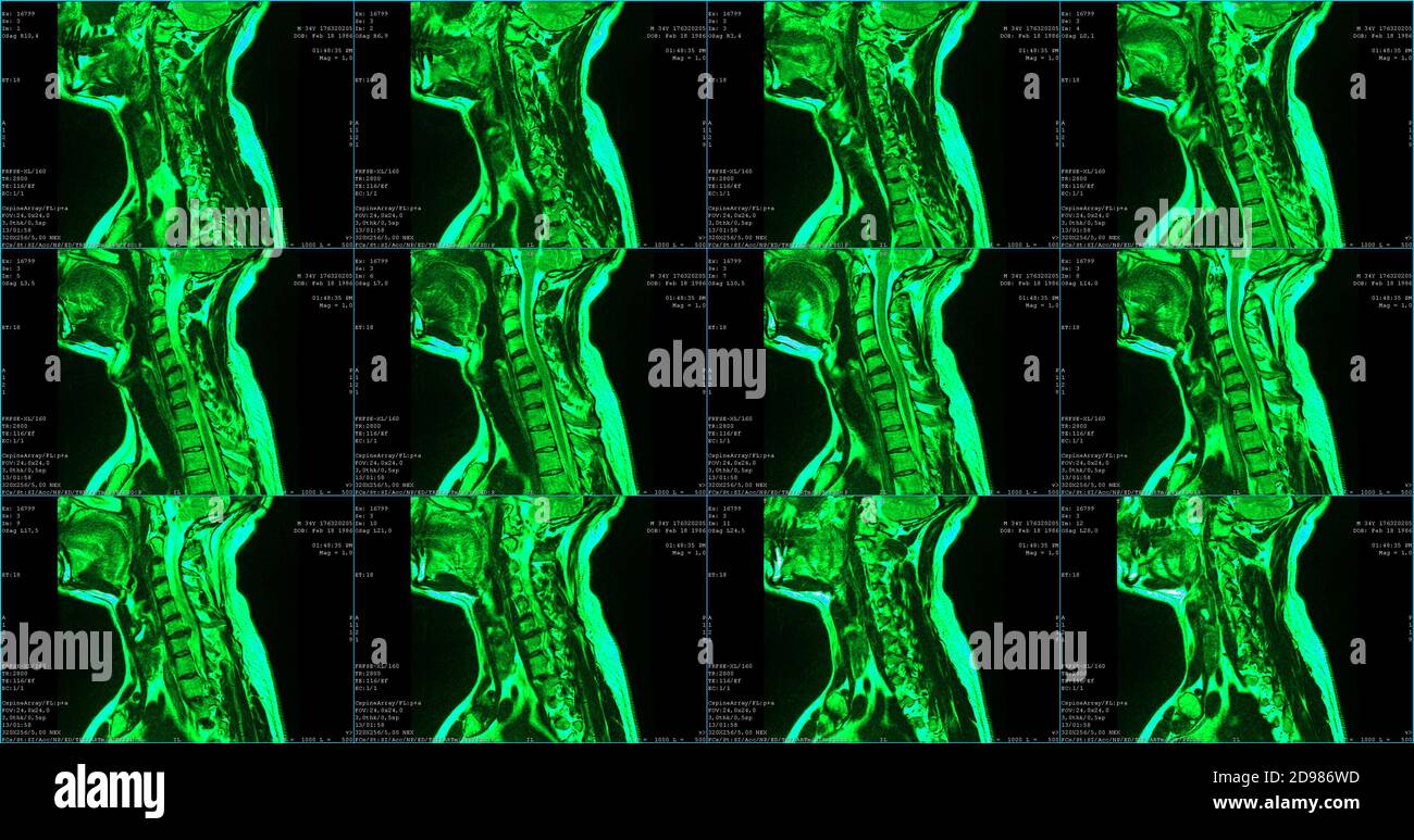 set of 6 sagittal green colored MRI scans of neck area of caucasian 34 ...