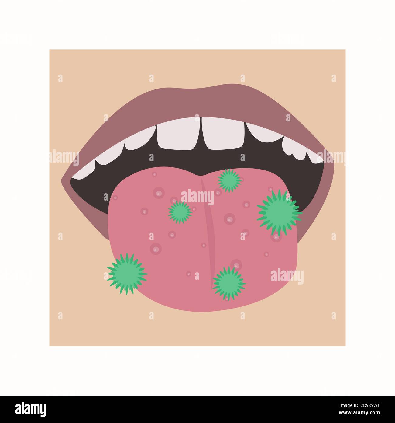 Symptom herpes tongue hi-res stock photography and images - Alamy