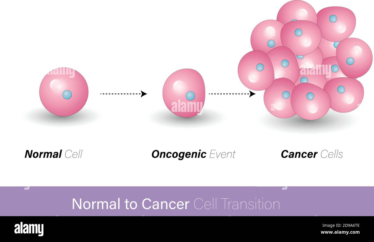 formation of cancer cells stages, development of a tumor. mechanism of ...