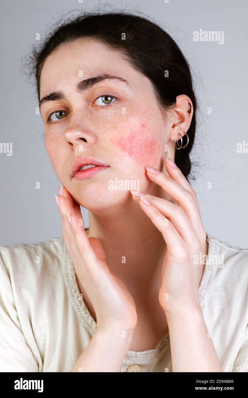 Portrait of a young Caucasian woman showing redness and inflamed blood ...