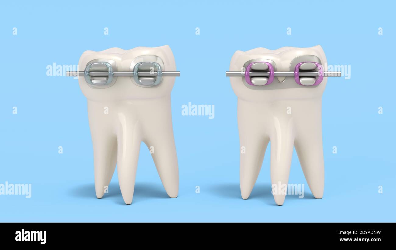 dental braces with plastic and metal base are installed on the tooth 3d ...