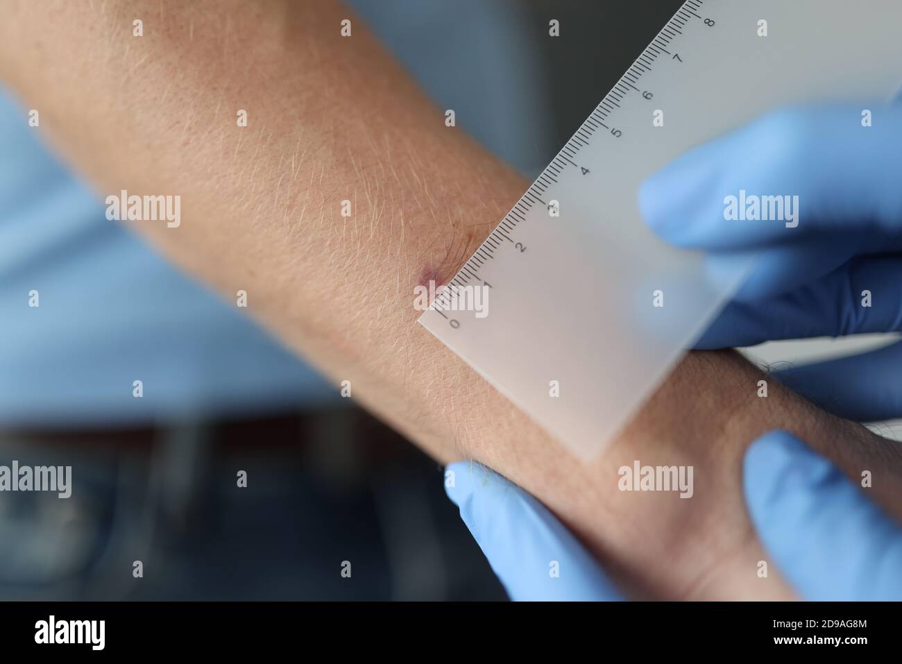 Oncologist doctor measuring tumor on patient's hand with ruler in ...