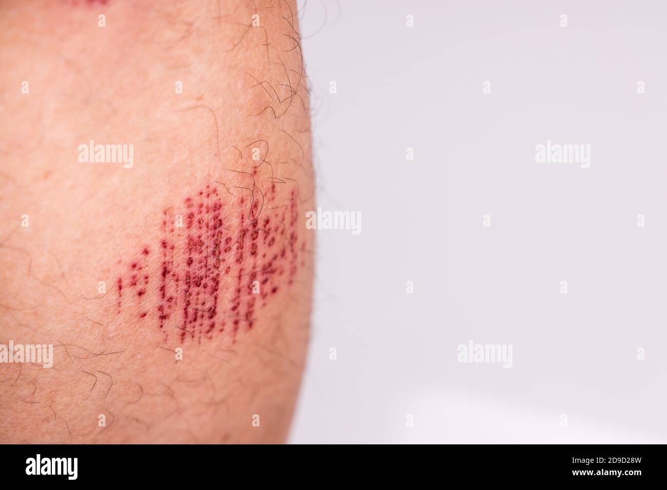 Person with painful injured leg result of abrasive fall Stock Photo - Alamy