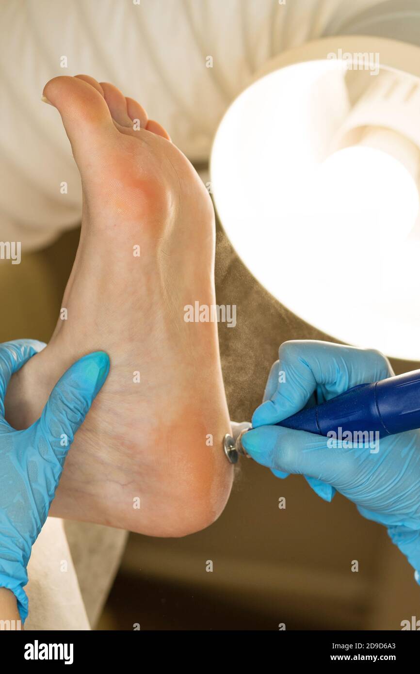 Podiatrist using grinding equipment and making procedure polish for ...