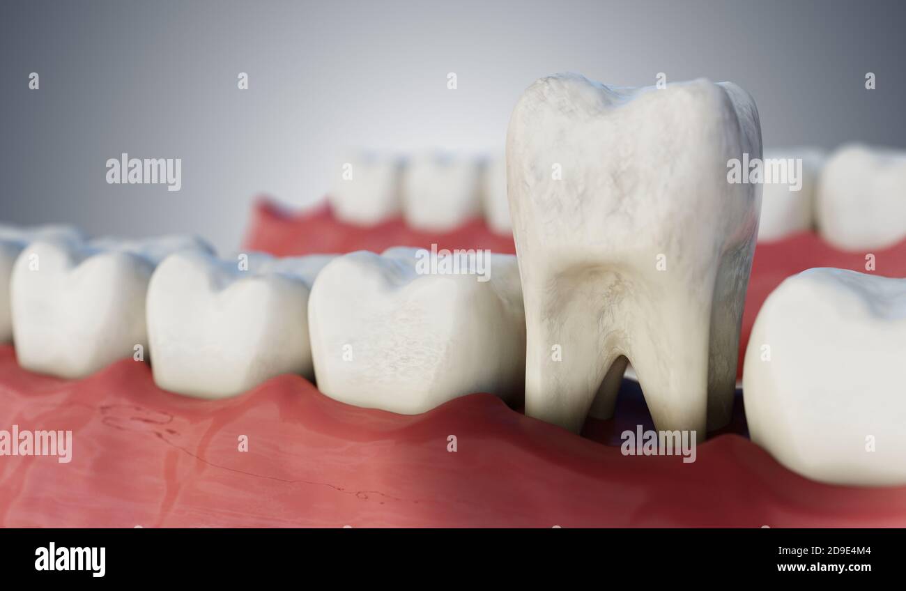 Tooth infected with cavities hi-res stock photography and images - Alamy