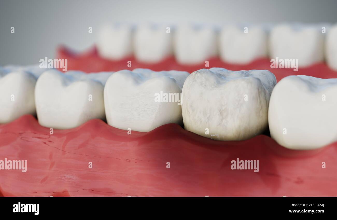 Infected tooth in mouth. 3D rendered illustration Stock Photo - Alamy