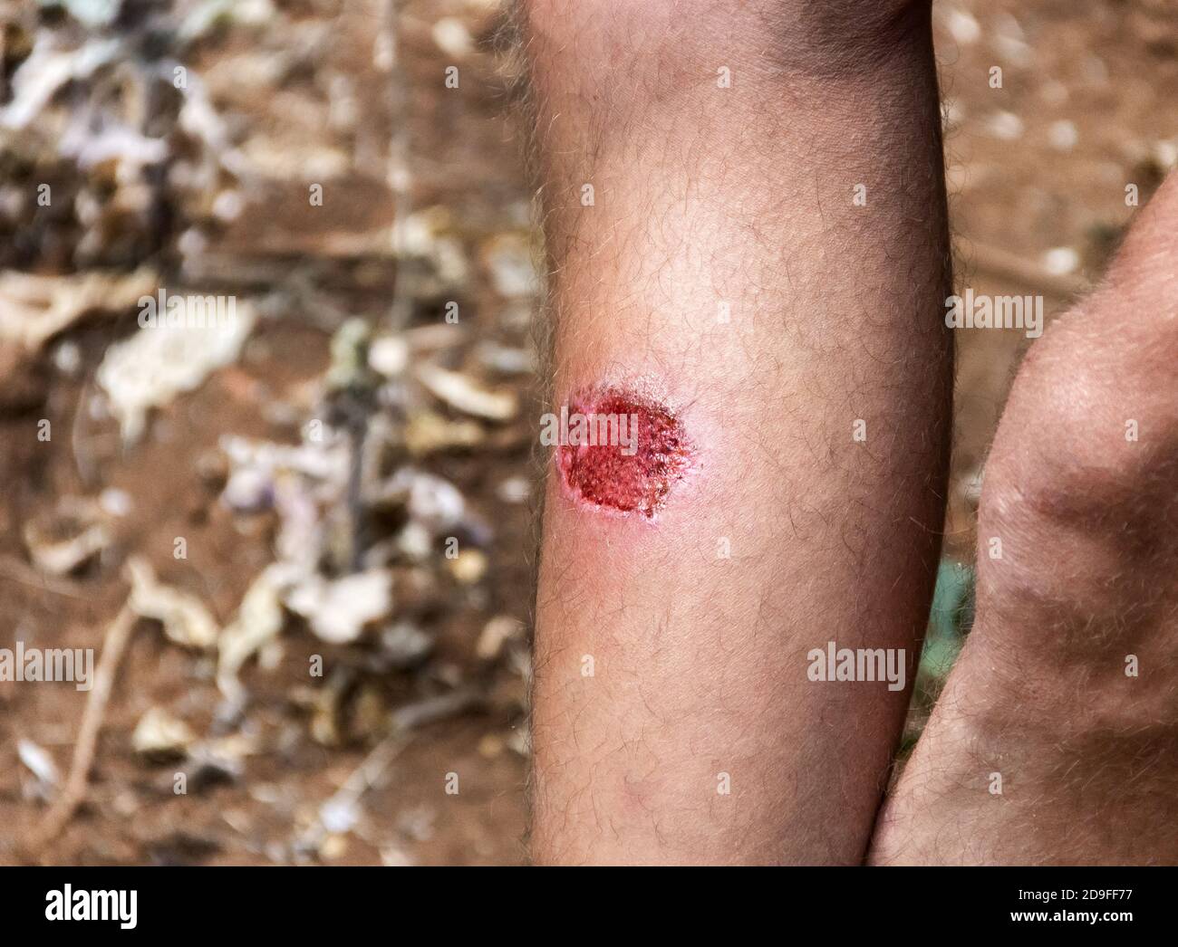 Skin cancer leg hi-res stock photography and images - Alamy