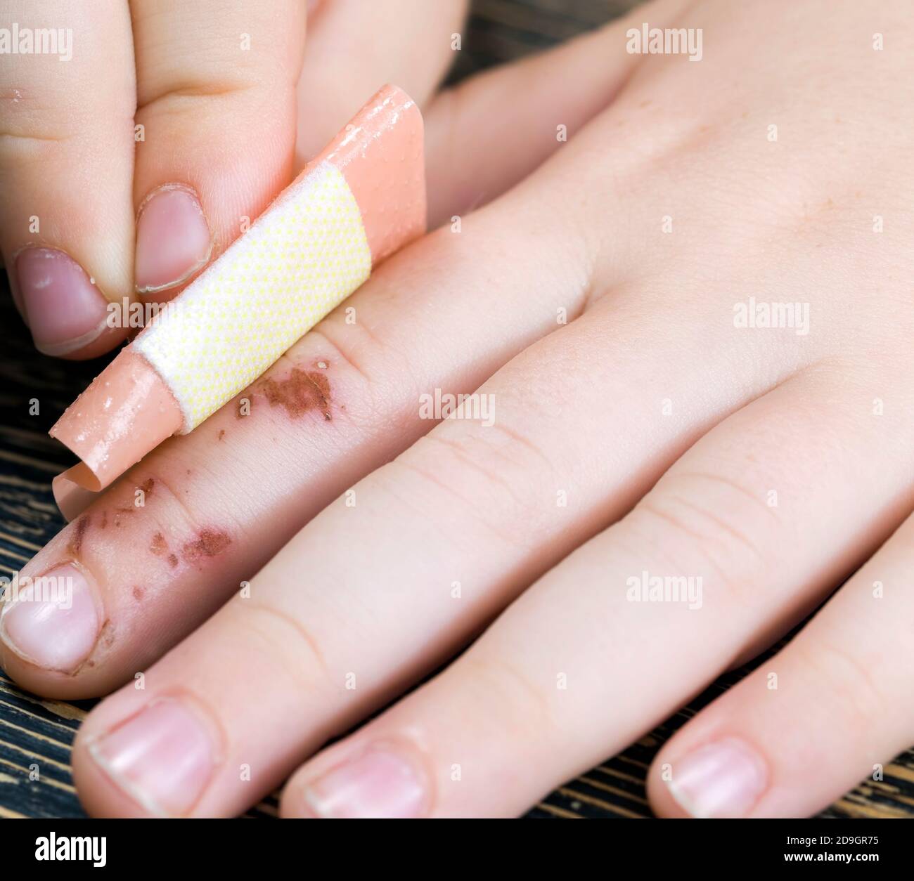 finger is already healing Stock Photo - Alamy