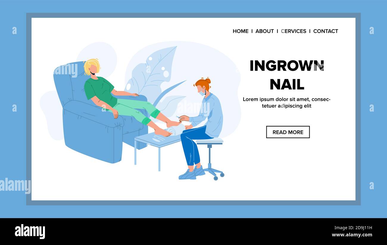 Ingrown Nail Medical Treatment Procedure Vector Illustration Stock ...