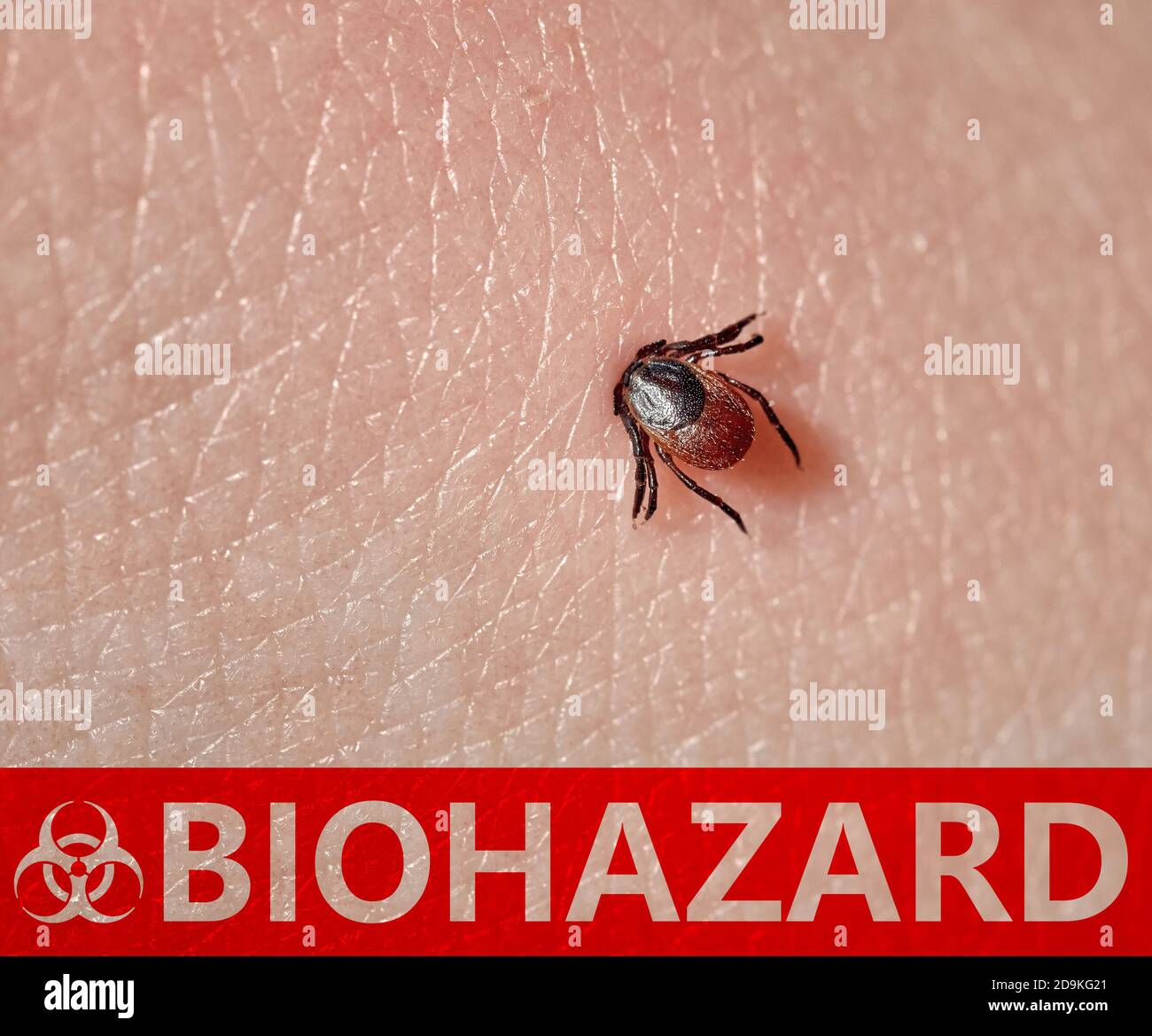 Sucking tick Macro photo on human skin. Ixodes ricinus. Bloated ...