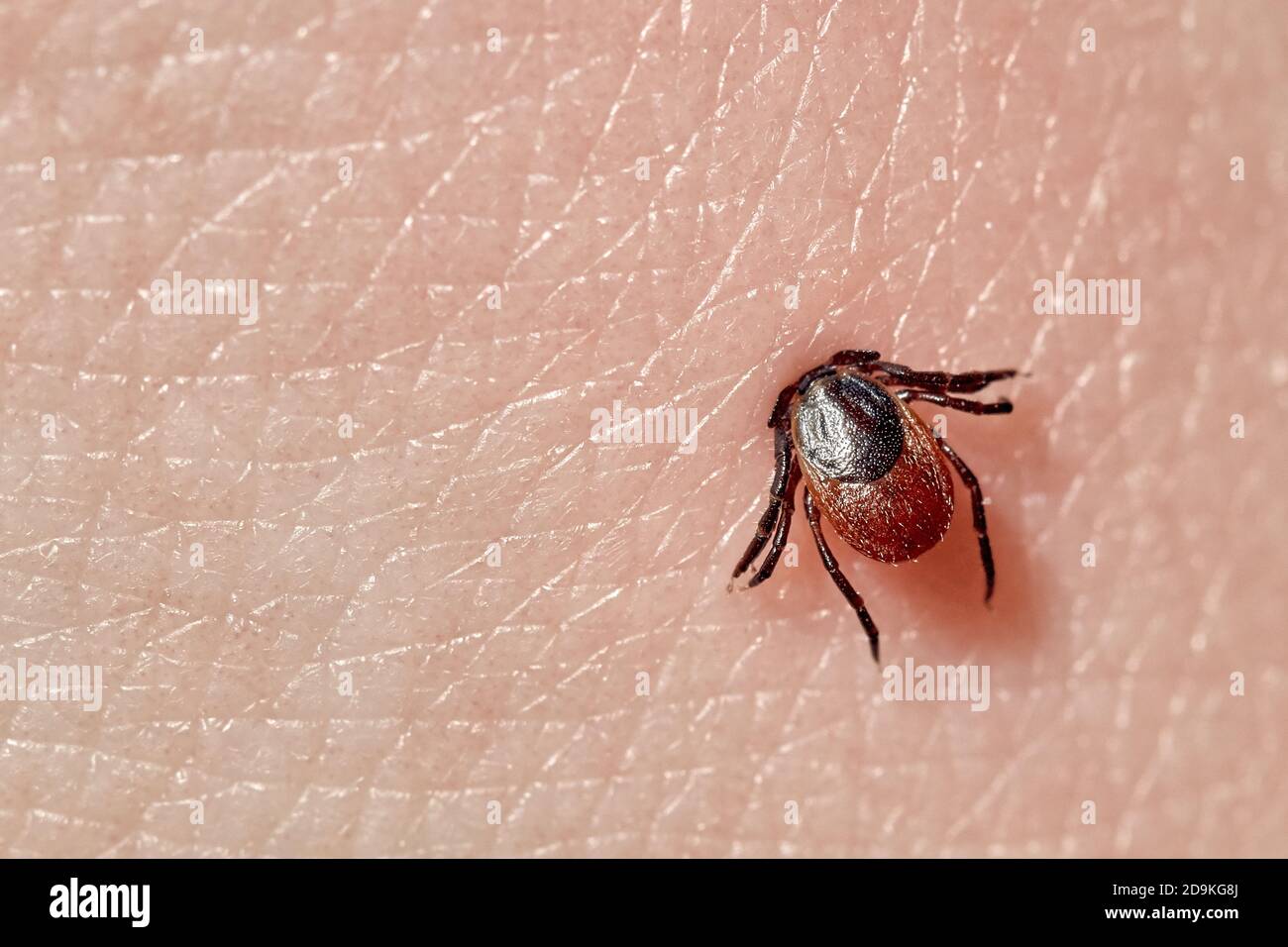 Sucking tick Macro photo on human skin. Ixodes ricinus. Bloated ...