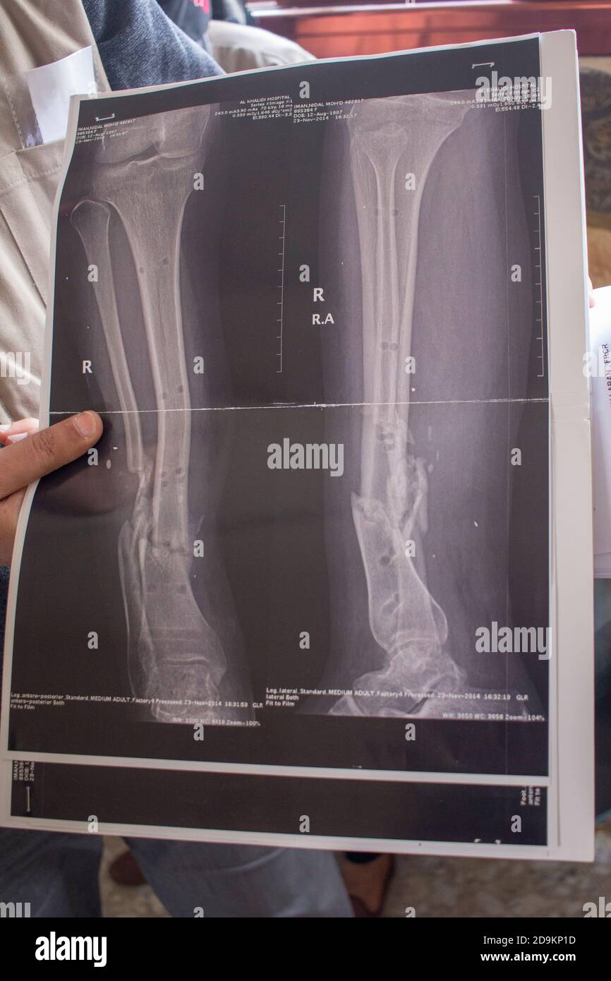 a girl suffered severe leg fractures after a tank shell hit her home ...