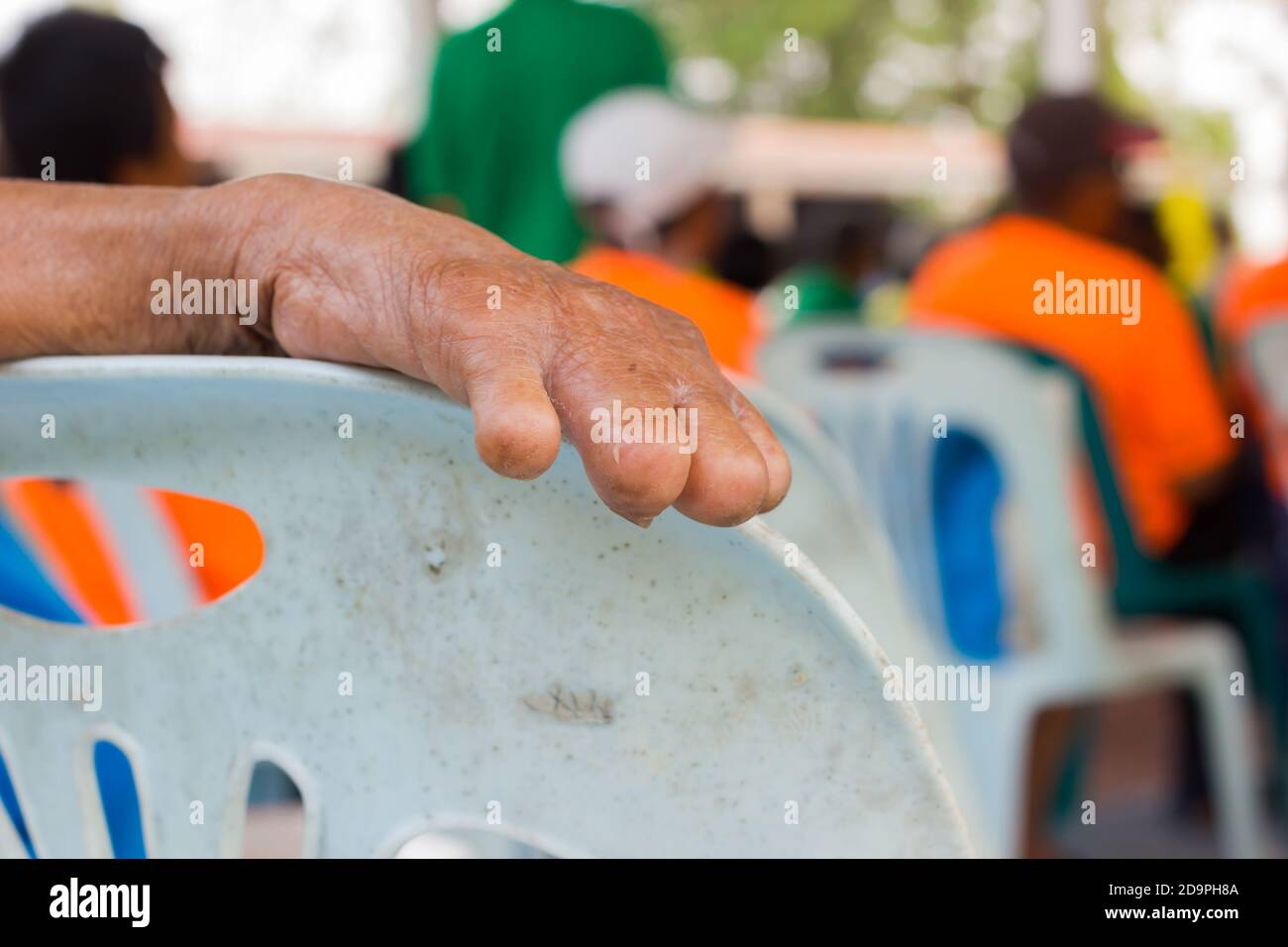 closeup hand of old asian woman suffering from leprosy, amputated hand ...