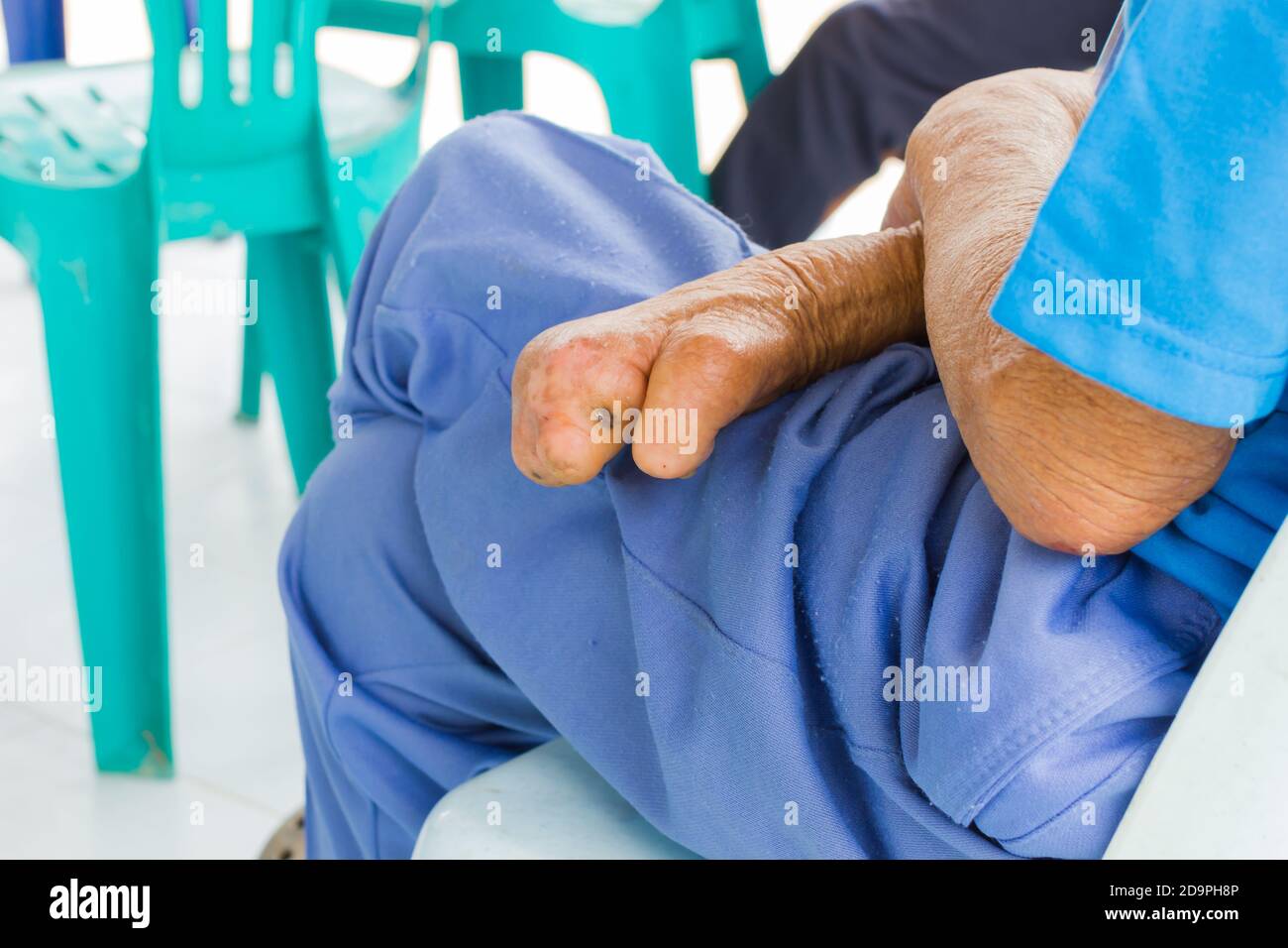 closeup hand of old asian man suffering from leprosy, amputated hand ...
