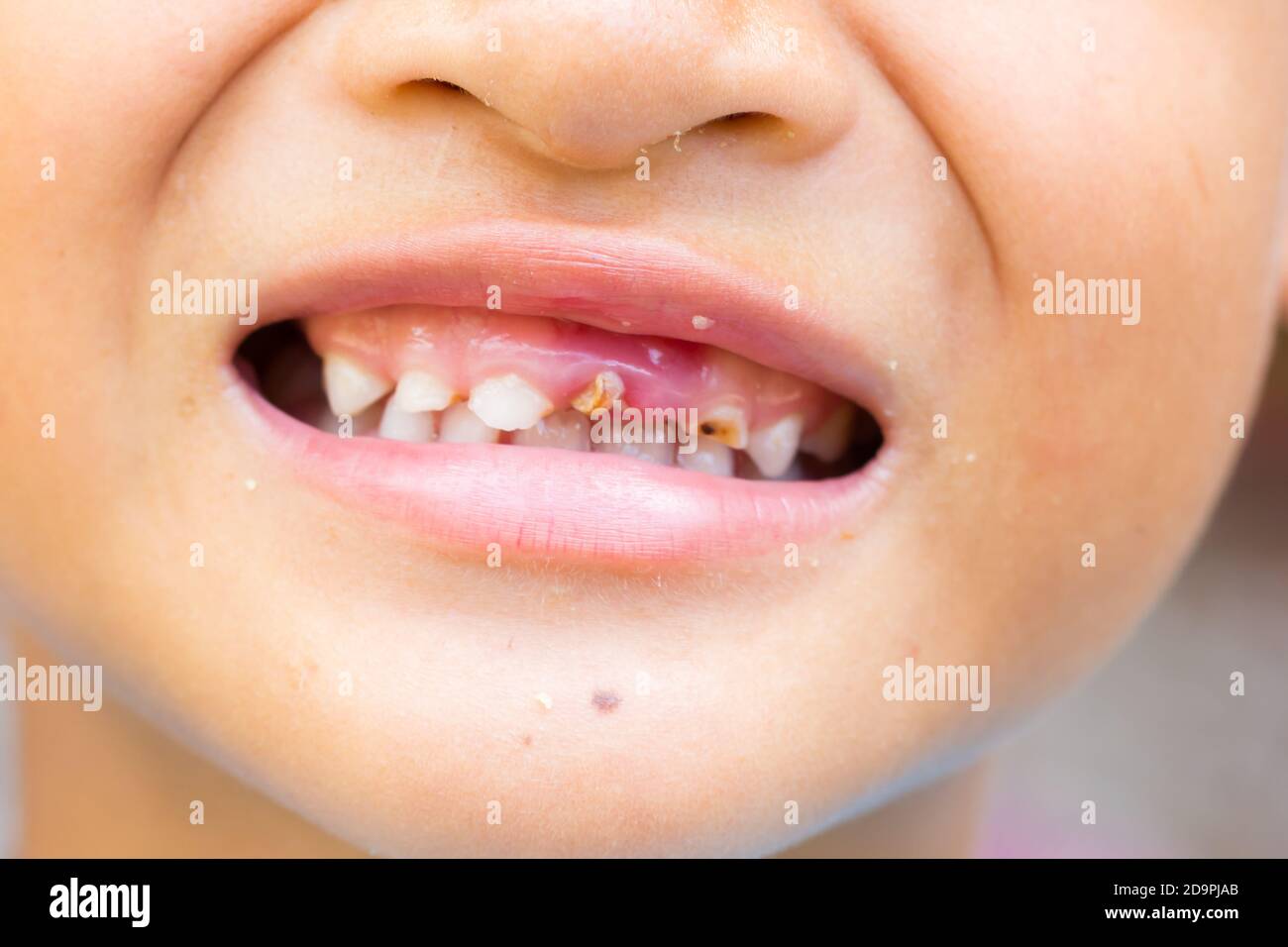 Boy broken teeth hi-res stock photography and images - Alamy