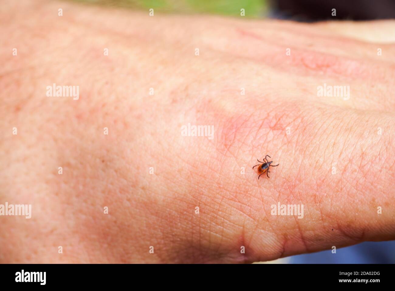 Scale tick, hard mite of family Ixodidae on human hand. It carrier of ...