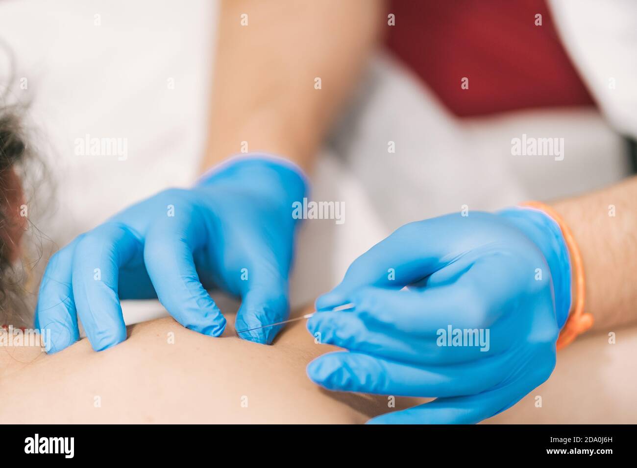Closeup of crop anonymous therapist inserting needles in back of ...