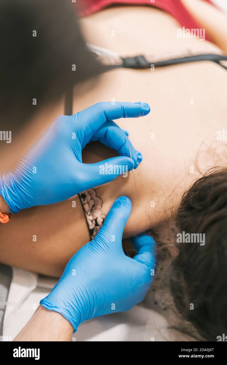 Closeup of crop anonymous therapist inserting needles in back of ...