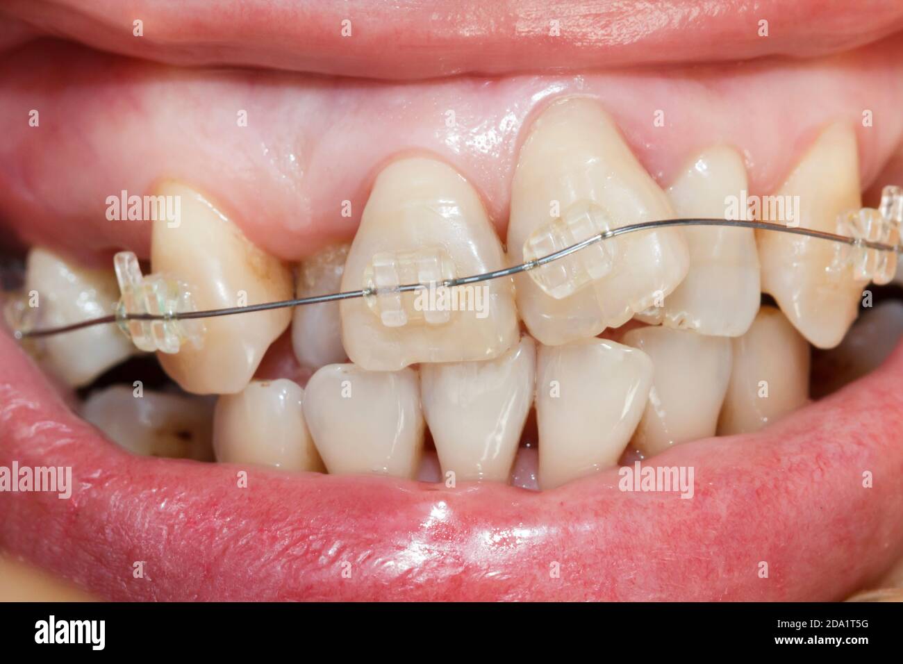 Crooked Front Teeth With Braces