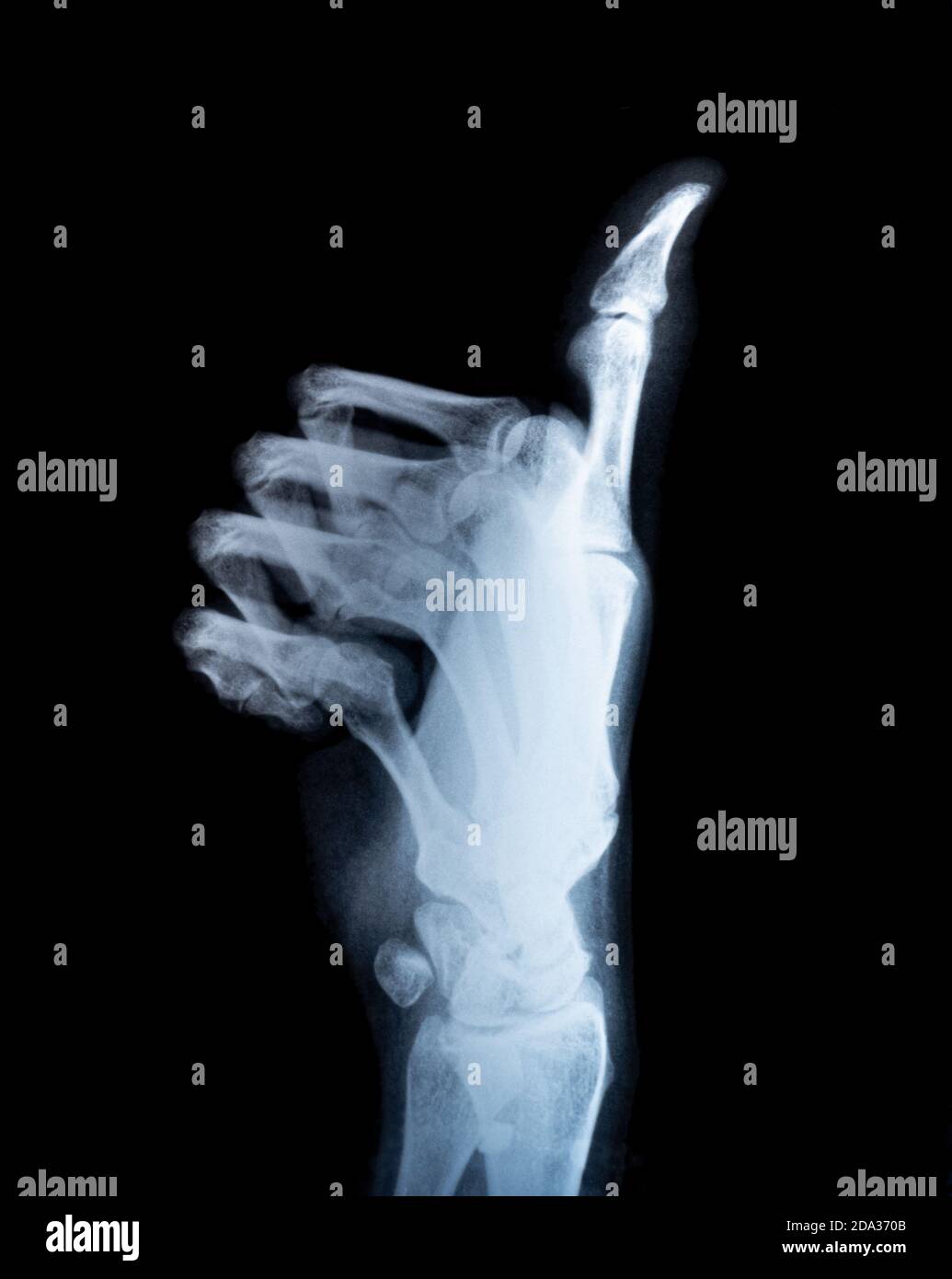 Broken hand x ray hi-res stock photography and images - Alamy