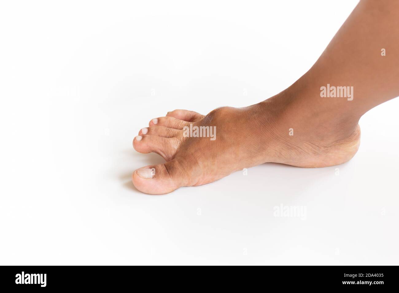 Hallux valgus, big abnormal feet bones of female feet on white ...