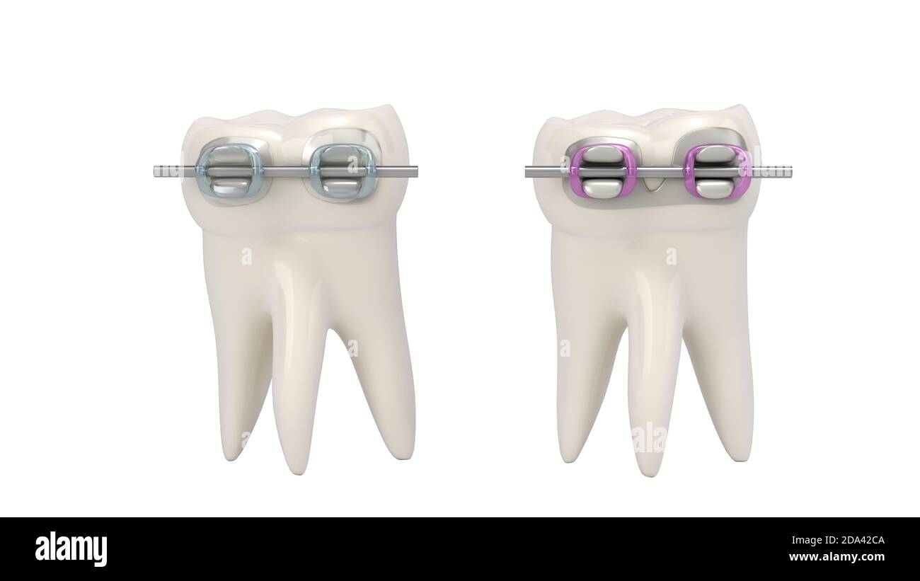 dental braces with plastic and metal base are installed on the tooth 3d ...