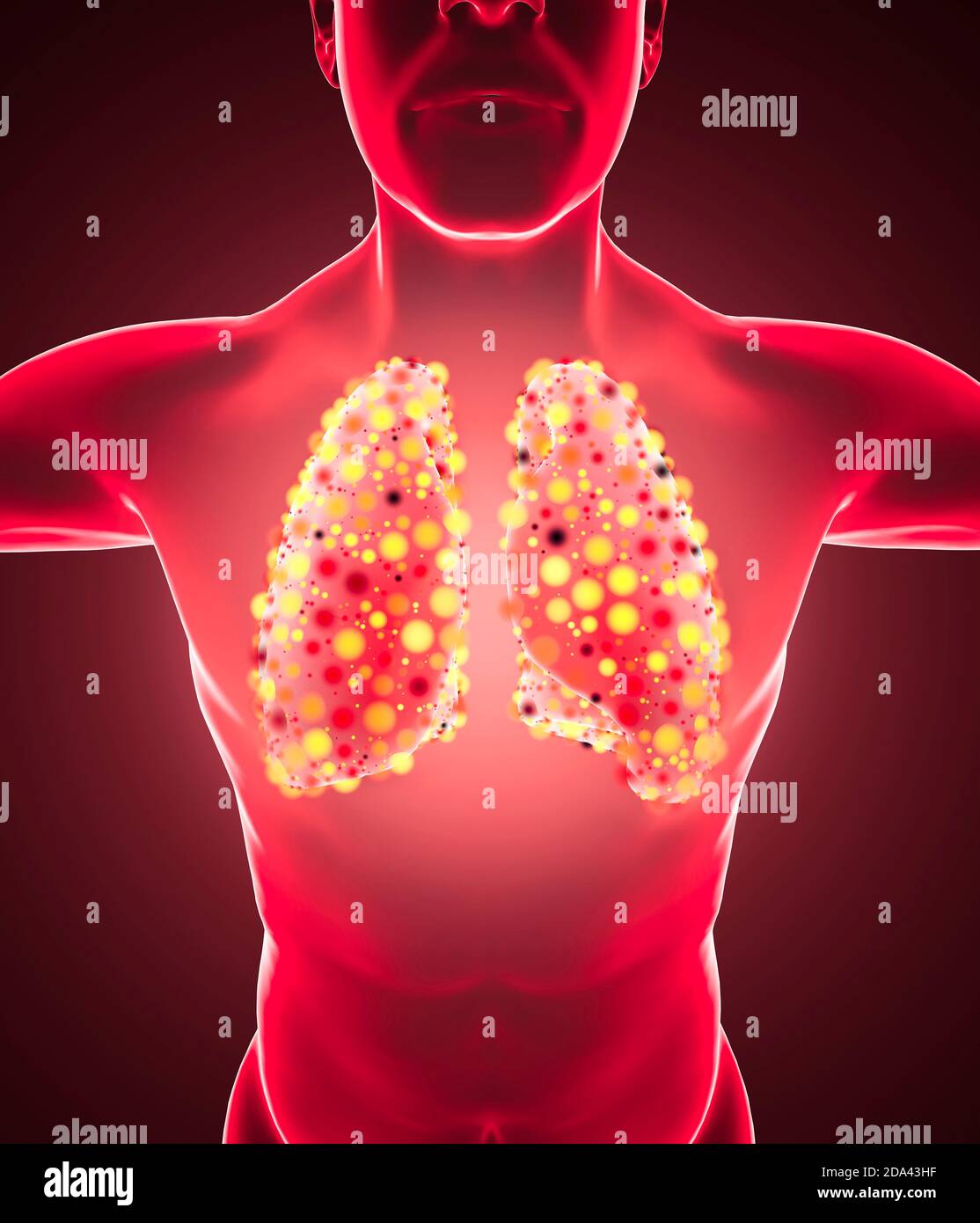 Human anatomy, problems with the respiratory system, severely damaged ...