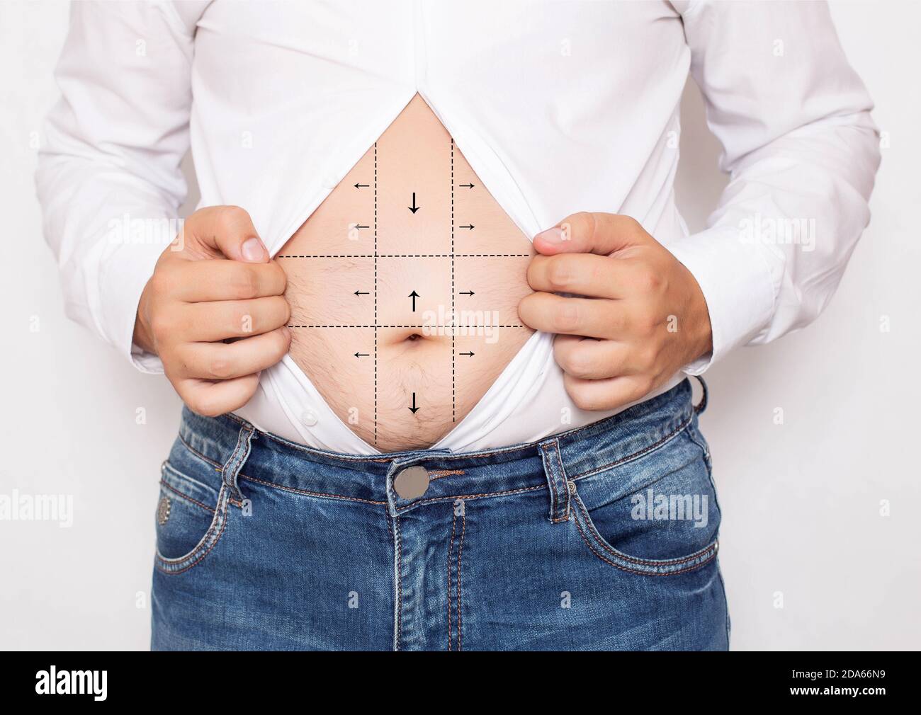 markers for plastic surgery to reduce belly fat of an office worker in ...