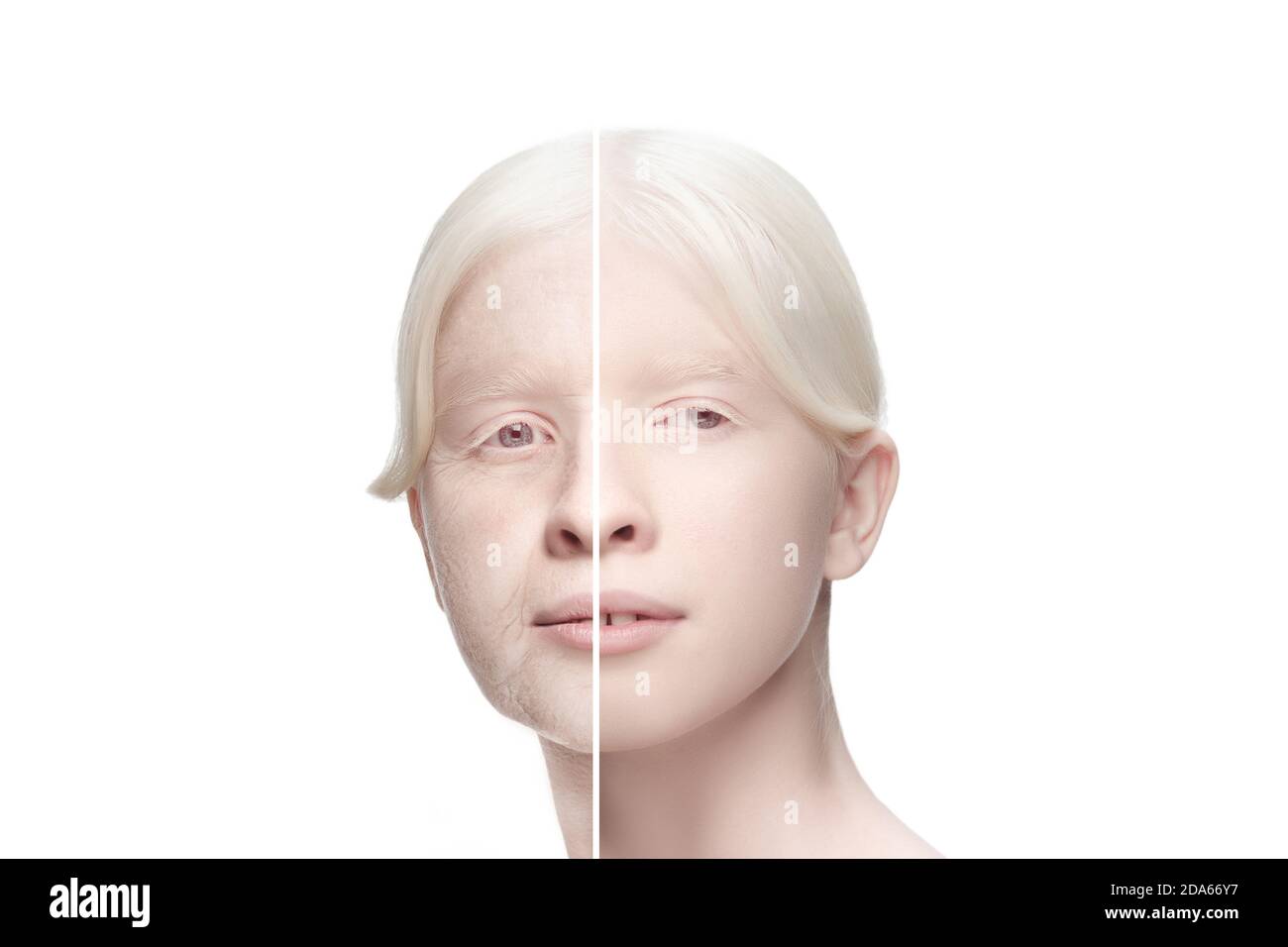 Comparison. Portrait of beautiful albino woman with problem and clean ...