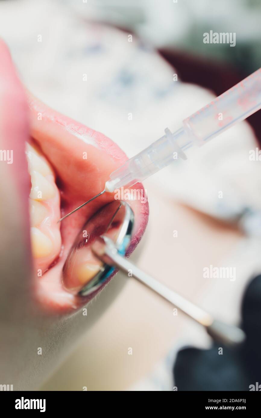 Dentist giving injection for anesthetizing his patient Stock Photo - Alamy
