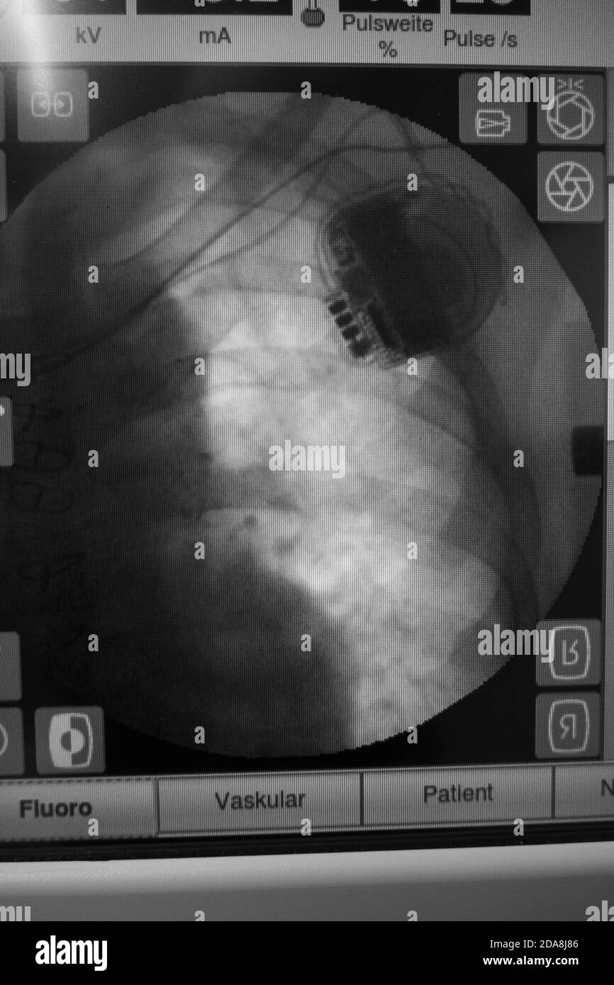 an implanted defibrillator can be seen on an X-ray image Stock Photo ...