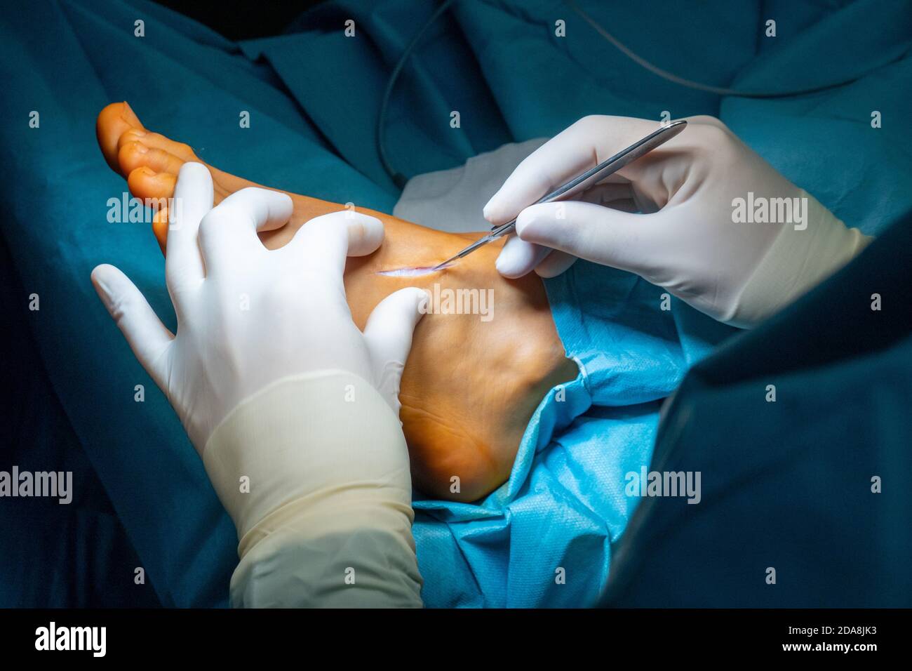 a surgeon makes an incision on one foot with a scalpel Stock Photo - Alamy