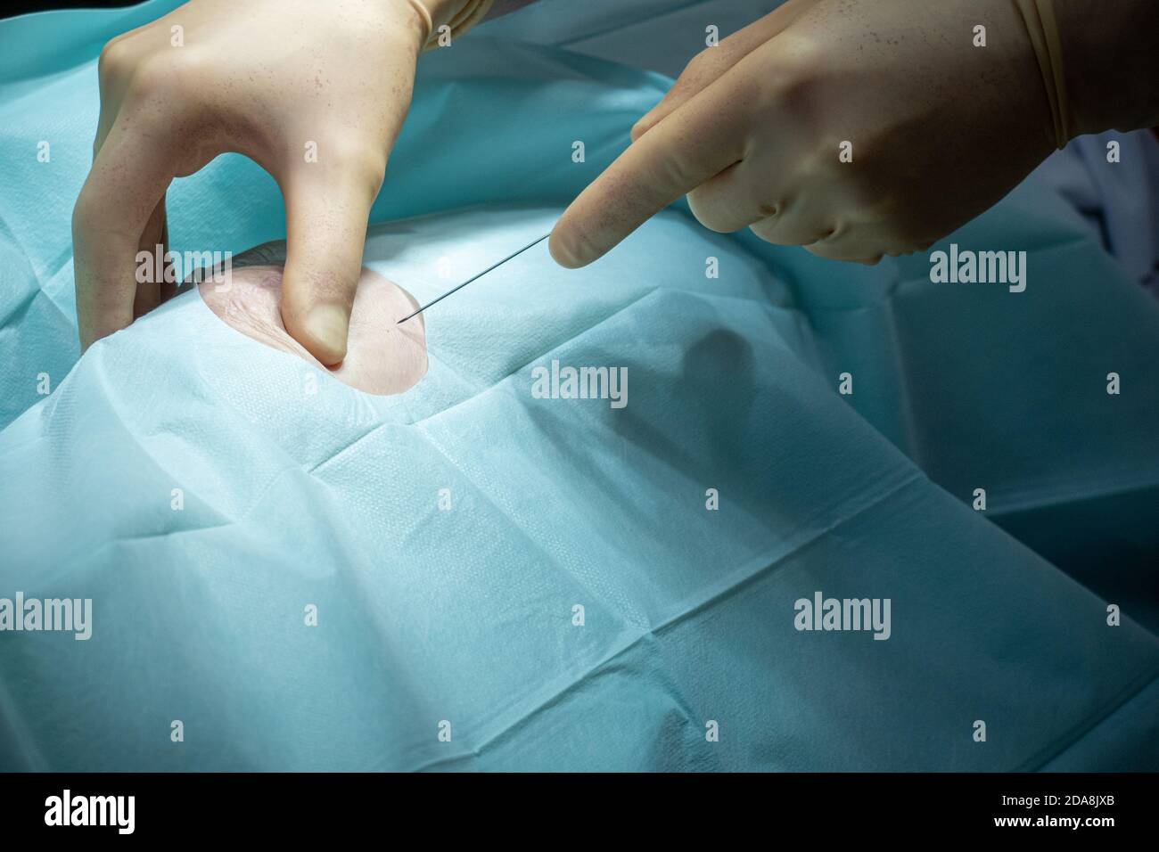 a doctor performs a knee puncture in an operating room with a cannula ...