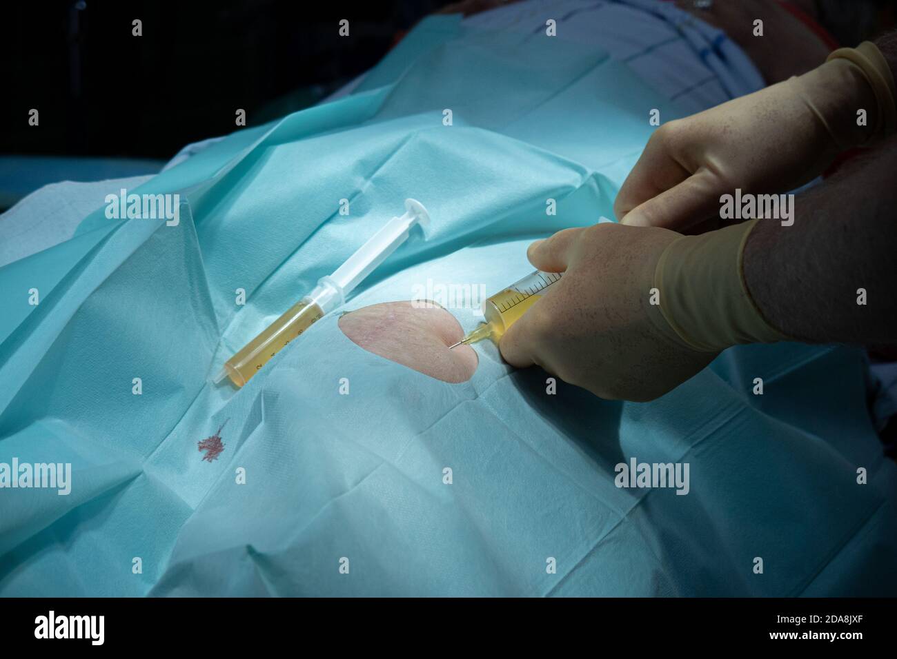 a doctor performs a knee puncture in an operating room with a cannula ...