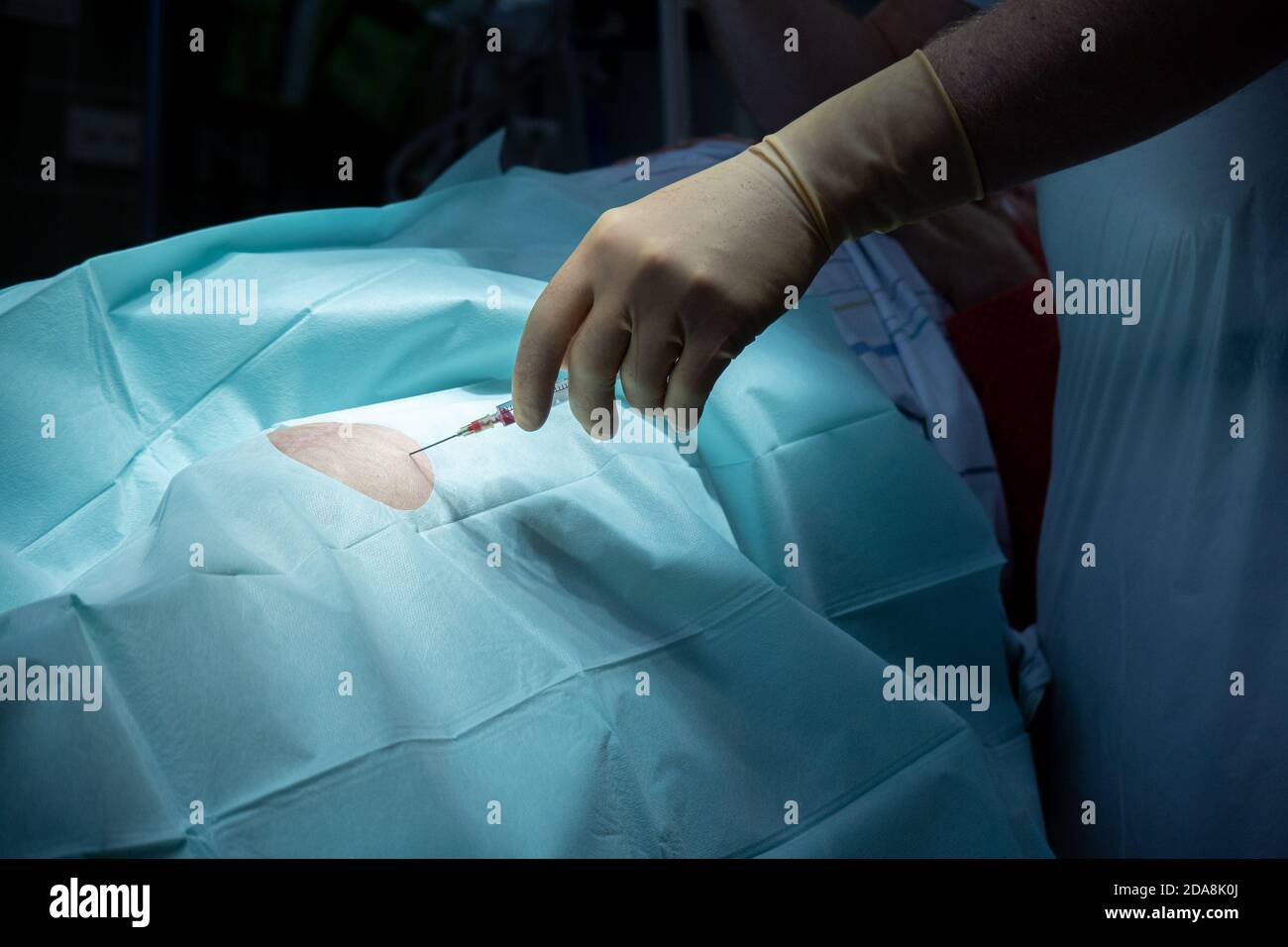 a doctor performs a knee puncture in an operating room with a cannula ...