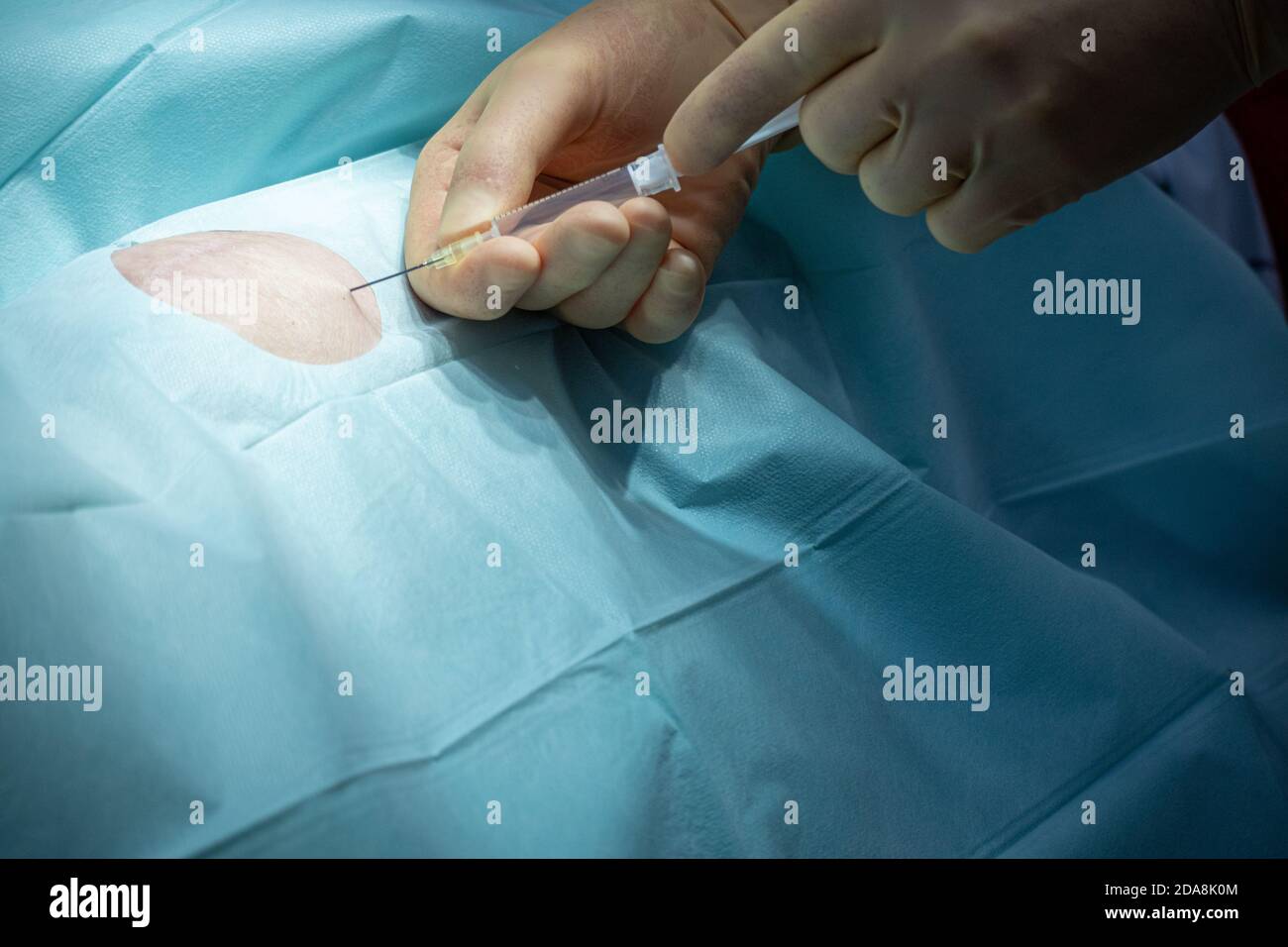 a doctor performs a knee puncture in an operating room with a cannula ...