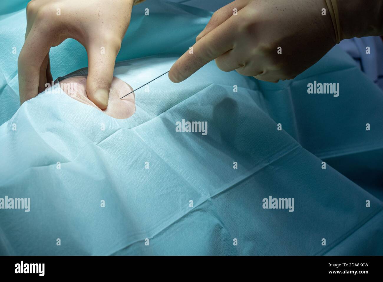 a doctor performs a knee puncture in an operating room with a cannula ...