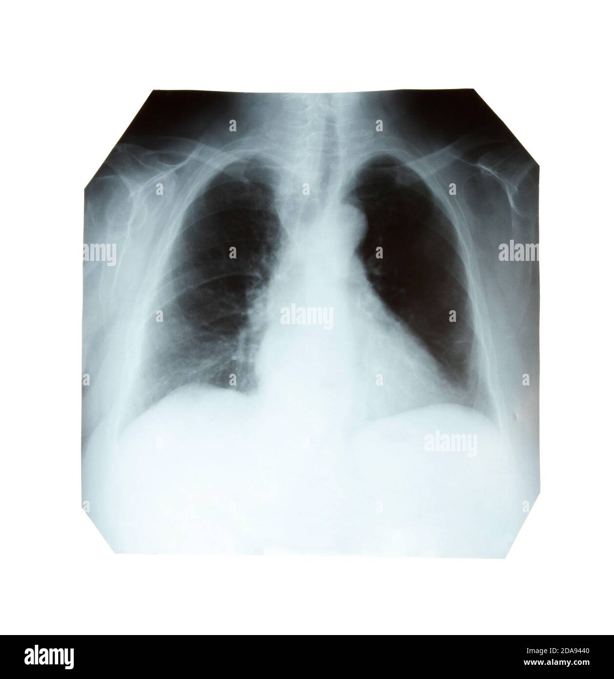 Chest x-ray isolated on a white background Stock Photo - Alamy