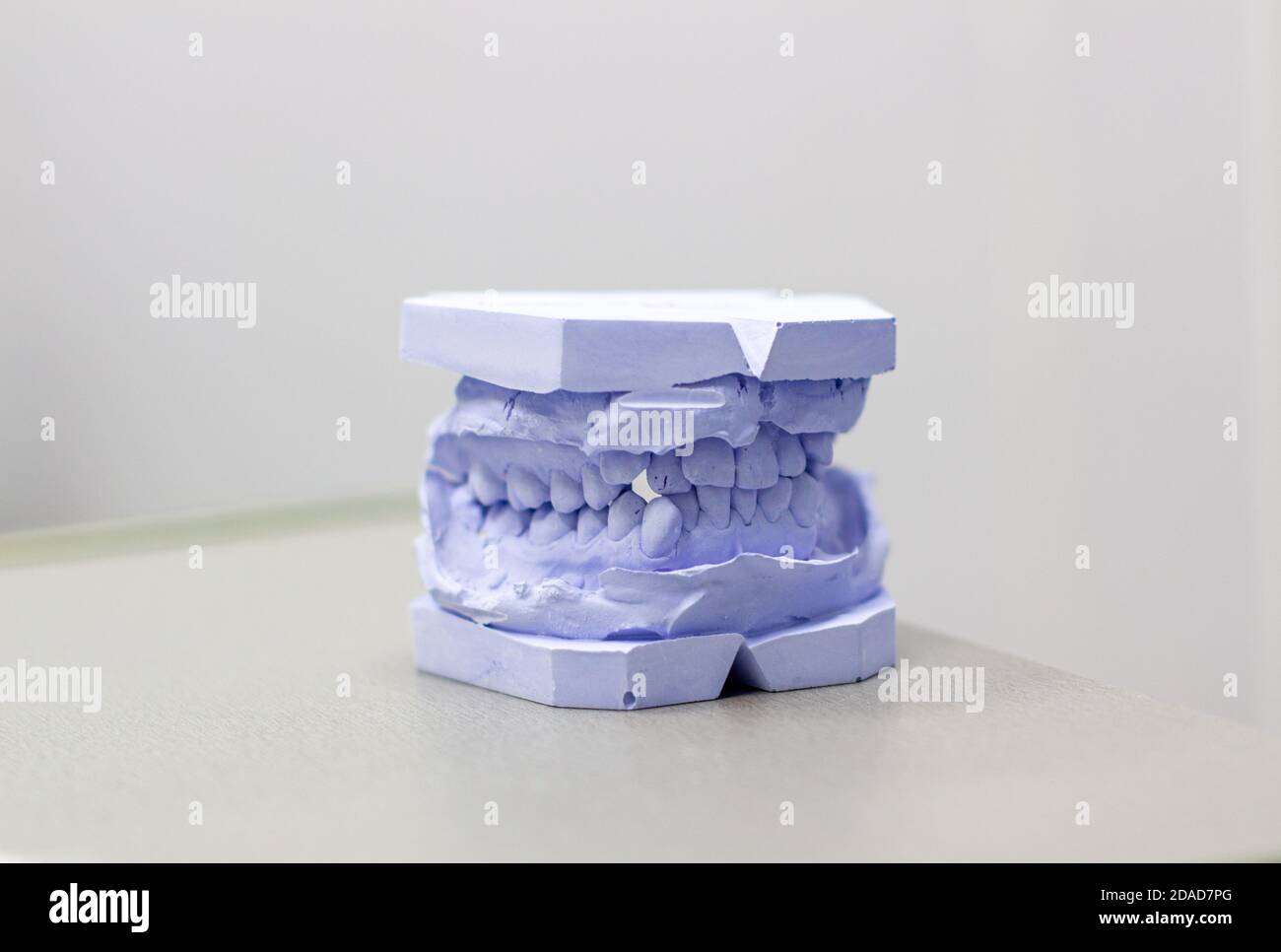 Plaster cast of teeth from plaster at the orthodontist Stock Photo - Alamy