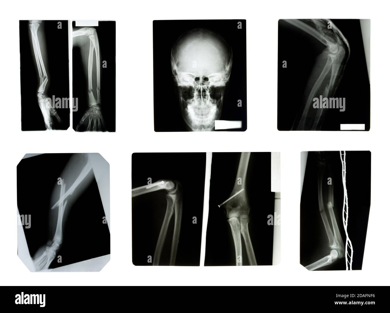 Bone scans hi-res stock photography and images - Alamy