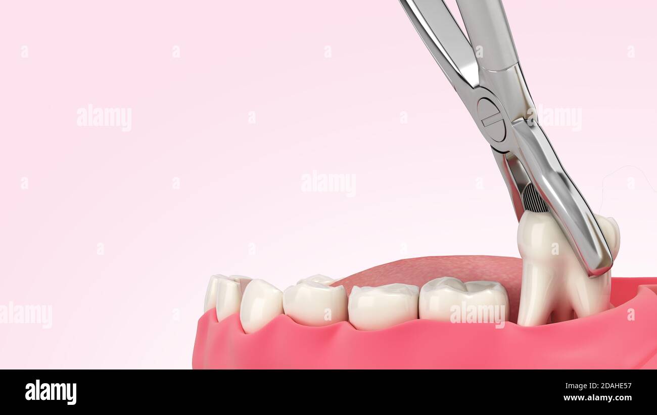 tooth clamped in medical extraction forceps dental services concept 3d ...