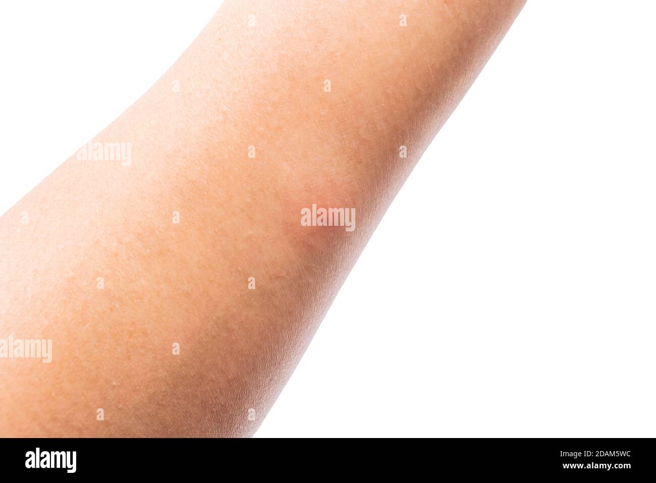 The close up photo of red spot swollen and allergies from insect bites ...